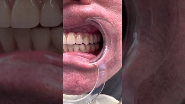 Зубы за 1 день - все зубы на 4 имплантах All on 4. Улыбка после установки постоянного протеза