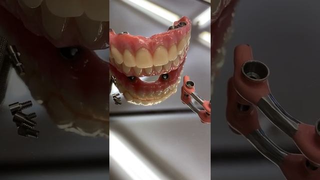 Протезы, армированные литой балкой и каркасом на титановой основе включены в стоимость  под ключ