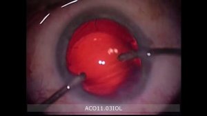 ACO11_03IOL