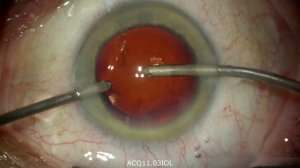 ACQ11_03IOL