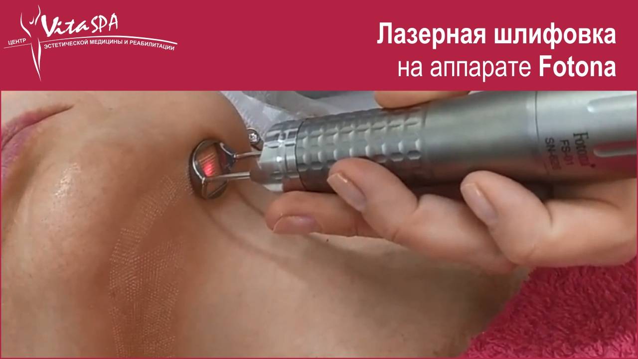 Лазерная шлифовка на аппарате Fotona