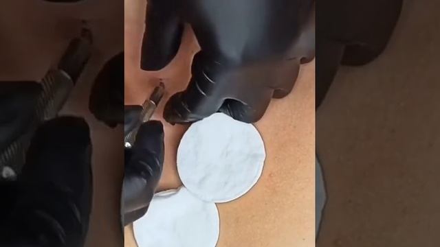 Утановка микродермала