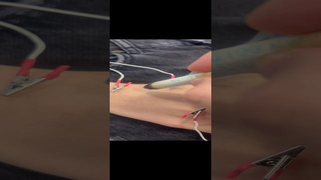 Электротермоакупунктура в лечении невропатии лучевого нерва 😊🥼