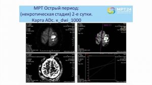 МРТ в диагностике недостаточности мозгового кровообращения