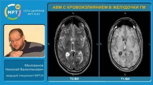 МРТ в диагностике аномалий и патологических изменений сосудов головного мозга