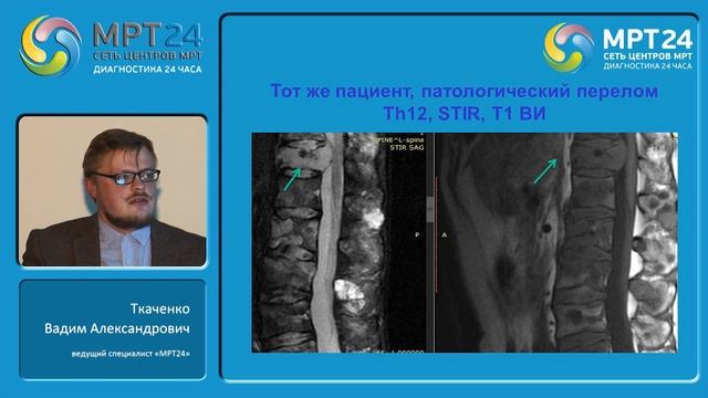 МРТ в диагностике объемных образований позвоночника и спинного мозга