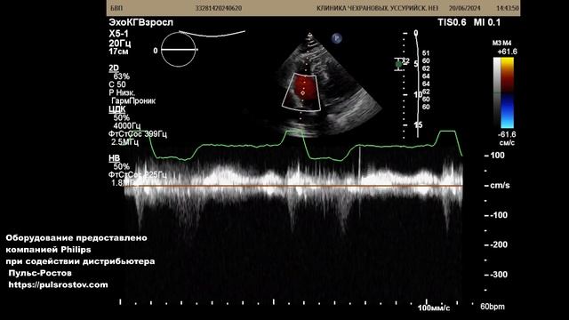 Электрокардиостимулятор. Нарушение кинеза миокарда