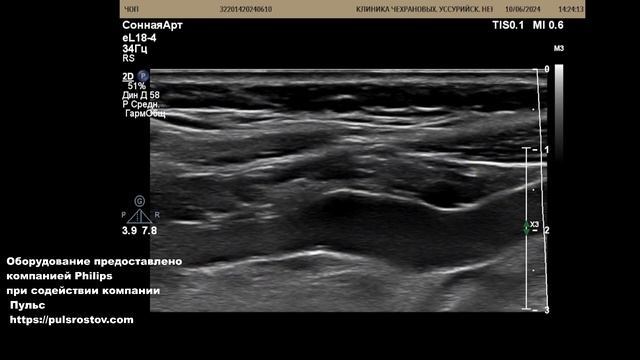 УЗИ сонных артерий. Самая частая находка ?