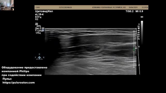 Узлы   УЗИ щитовидной железы.