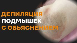Депиляция подмышек воском