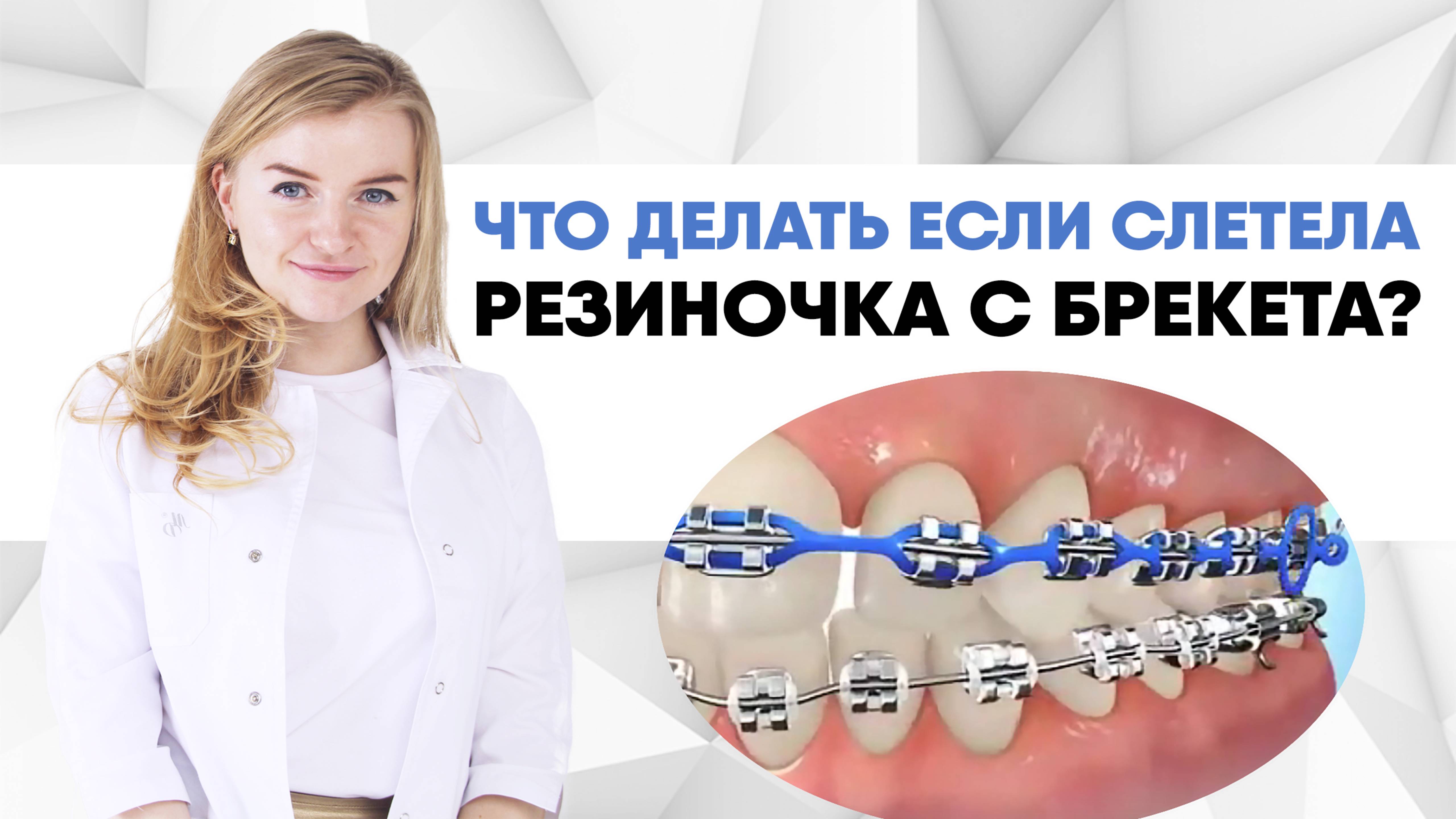 Что делать, если слетела резиночка с брекета?