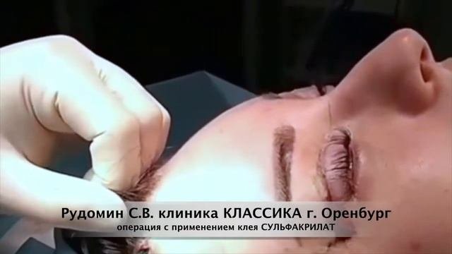 Эндоскопический фронто-темпоральный лифтинг с  помощью кожного клея.