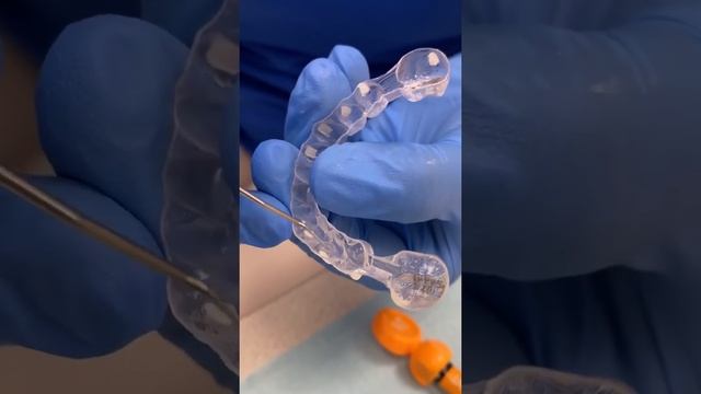 Элайнеры Invisalign