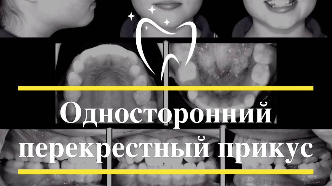 💥 Односторонний перекрестный прикус