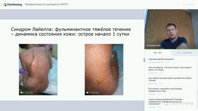 Непереносимость препаратов ПИТРС