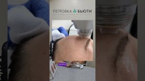 Микроигольчатый RF-лифтинг Инфини: рассказывает врач