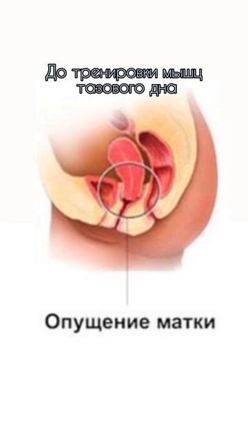 Callibri BeFit поможет устранить проблему с опущением матки