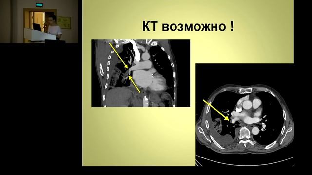 Тромбоэмболия легочной артерии Kошкина Е В