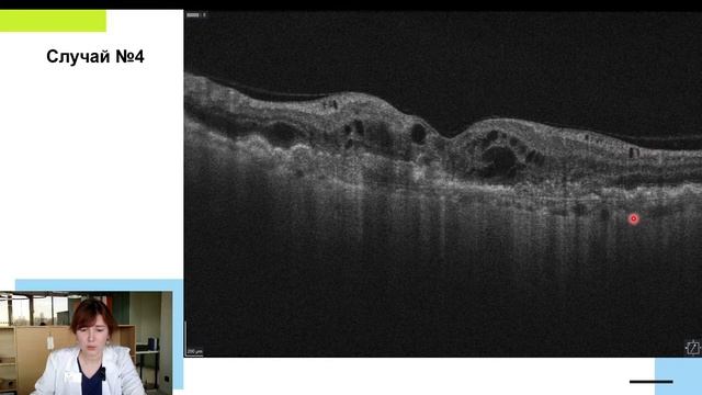 Взгляд сквозь слои: эффективные подходы к анализу снимков ОКТ