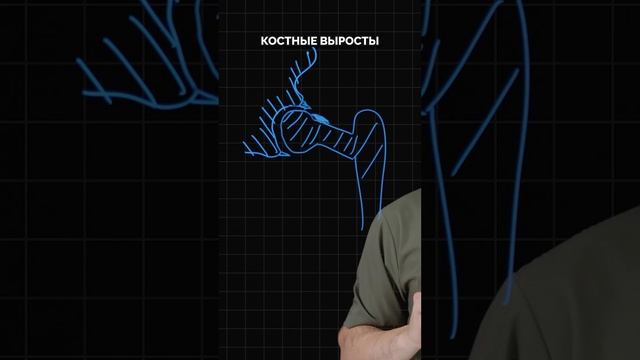 Фемороацетабулярный импинджмент