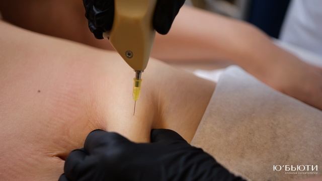 Процедура Карбокситерапия