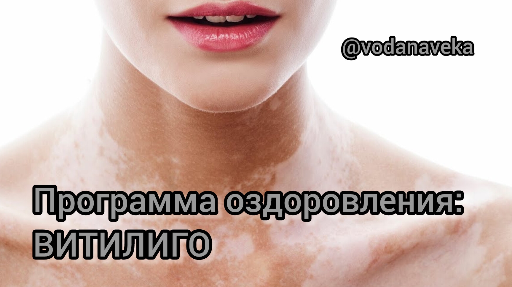 Витилиго. Программа оздоровления