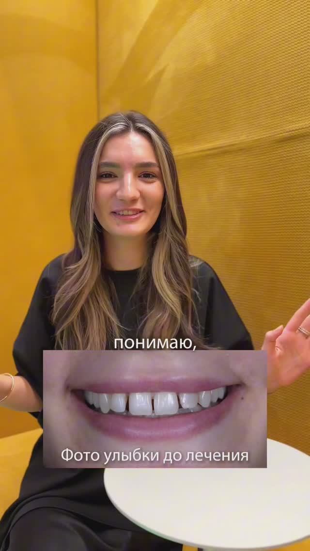 Установка виниров. Отзыв