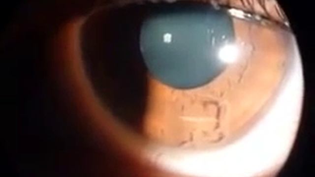 Гельминты в ГЛАЗАХ