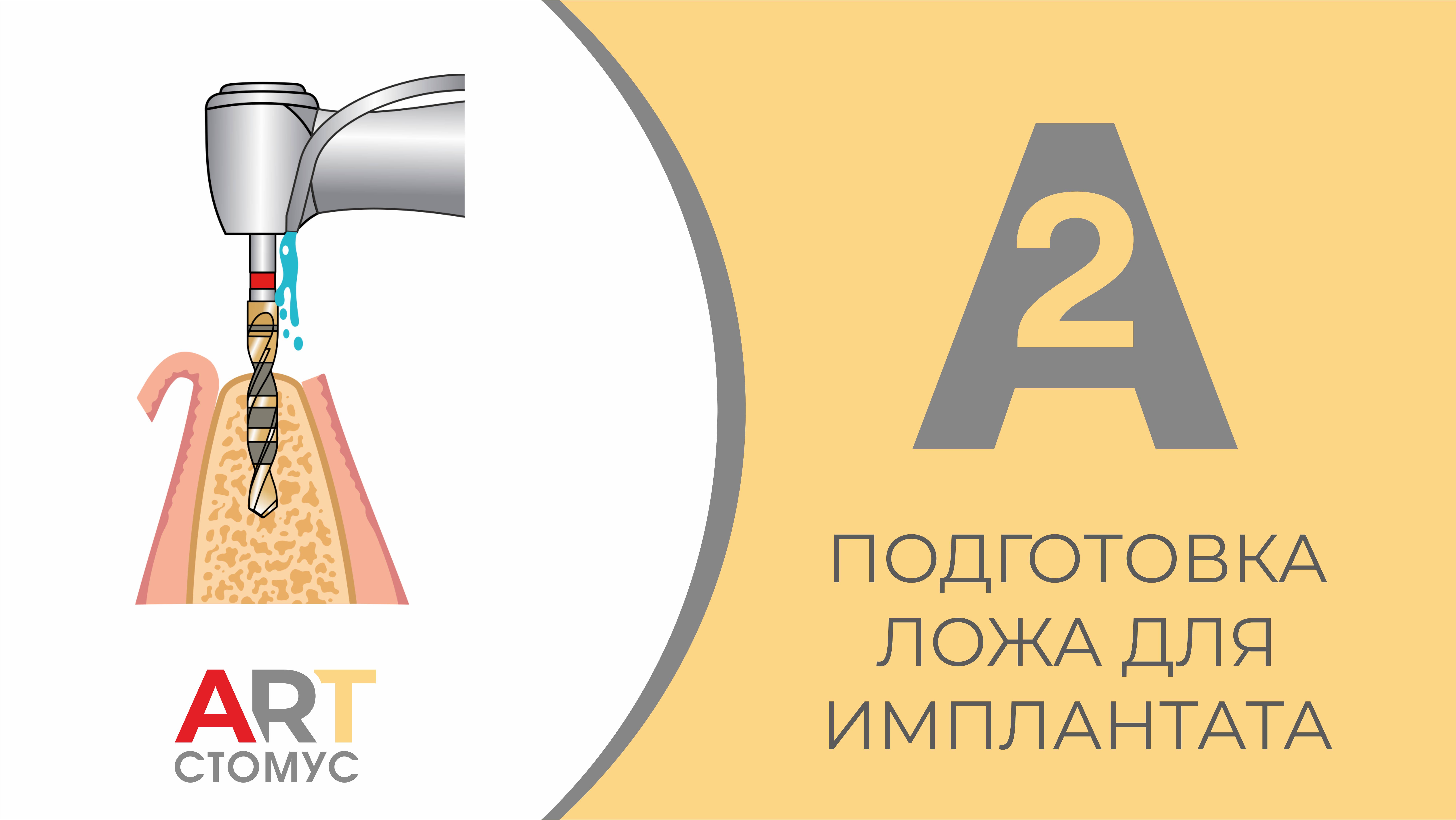 ПОДГОТОВКА ЛОЖА ДЛЯ ИМПЛАНТАТА А2