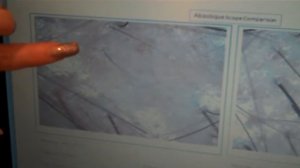Mens Hair Loss Treatments - Results tracked with a Microscope