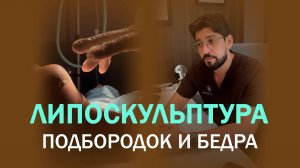 Липоскульптура: новые контуры тела за одну операцию