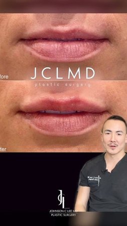 Plastic Surgeon Reacts to his Lip Filler Results | Dr. Johnson C. Lee | Beverly Hills, CA