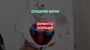 Виды фиксации матки при опущении