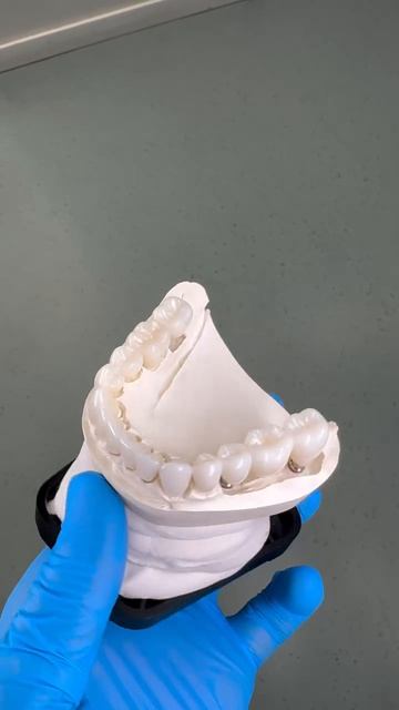 Виниры 🦷