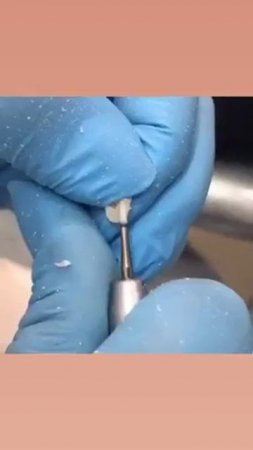Fechamento de Diastema