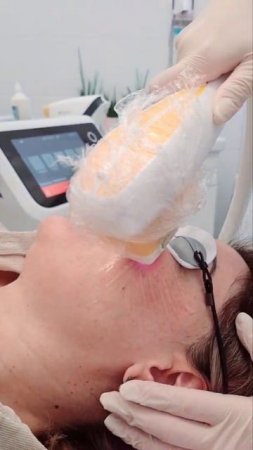 Удаление пигментного пятна