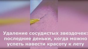 Микросклеротерапия: успеть до лета!! Хотите красивые ножки? после дние деньки!