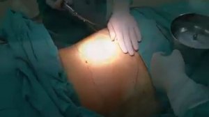 QuadroStar+_Лазер_асистированный_липолиз_laser_ms_ru