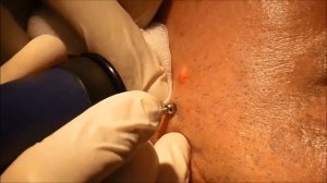 Удаление_новообразований_на_эрбиевом_лазере_Dermablate_MCL31_в_дерматологии