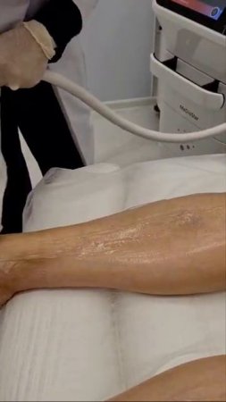 Лазерная эпиляция