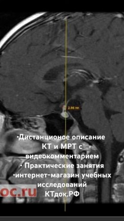 Гипофиз при несахарном диабете