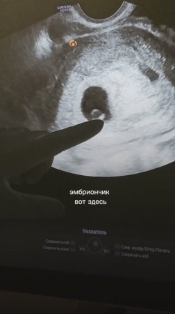 Беременность ЭКО