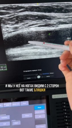 У Женщины нет Бляшек, но это не так!