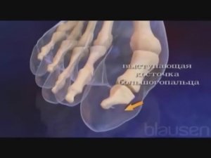 ВАЛЬГУС или косточки на ногах - ЛЕЧЕНИЕ