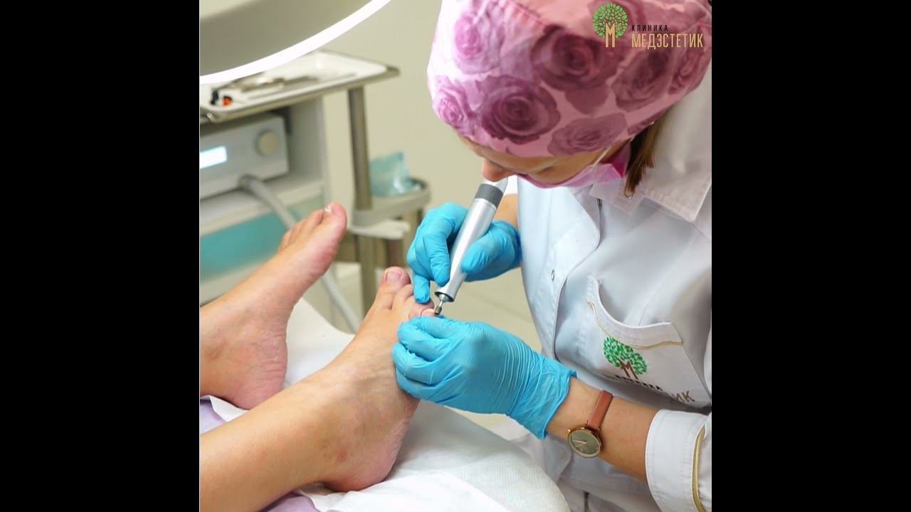 Медицинский педикюр
