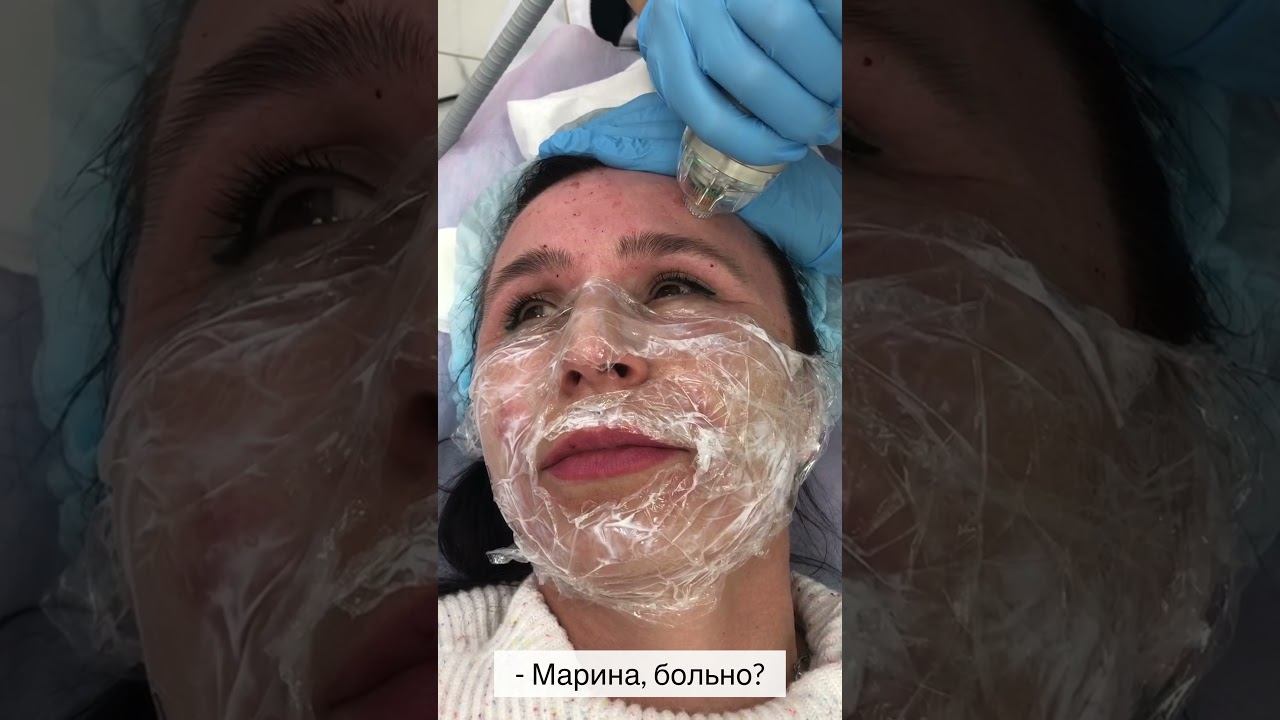 Микроигольчатый RF-лифтинг EndyMed