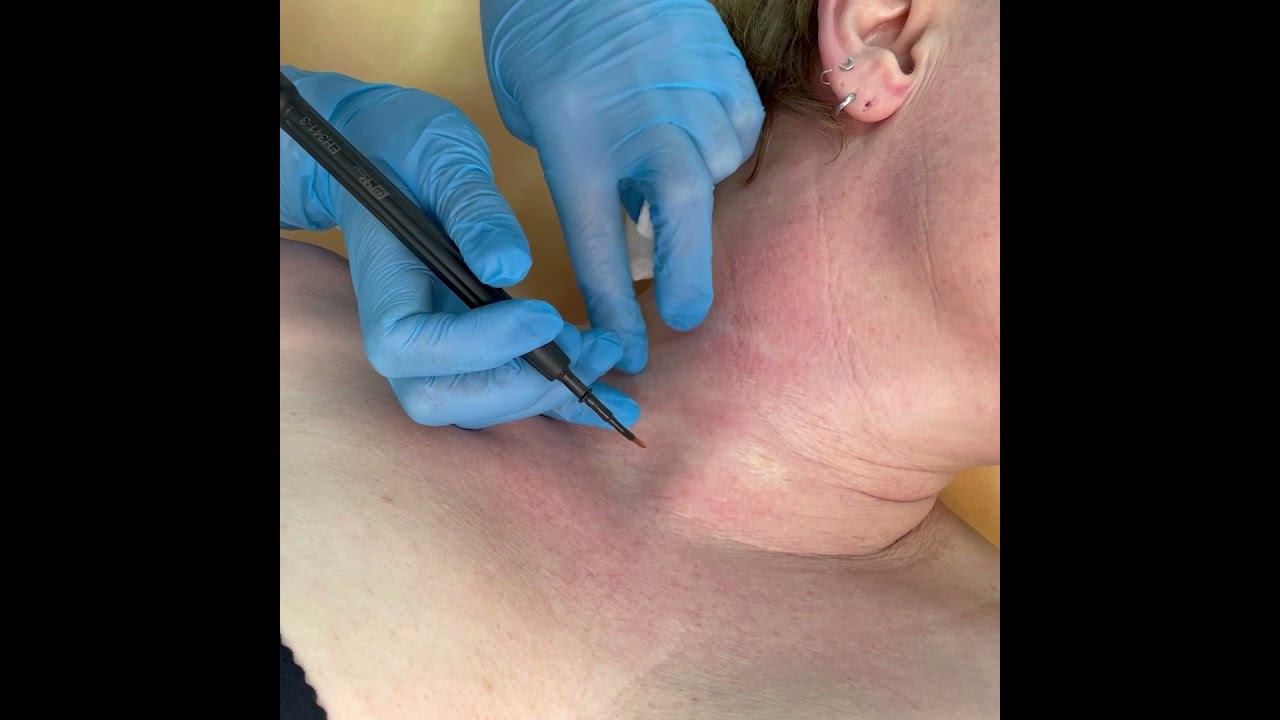 Радиохирургическое удаление папиллом