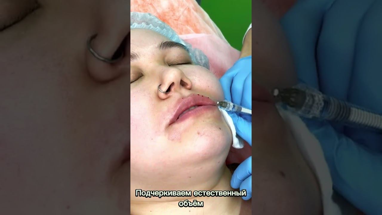 Увеличение губ Belotero Lips Shape