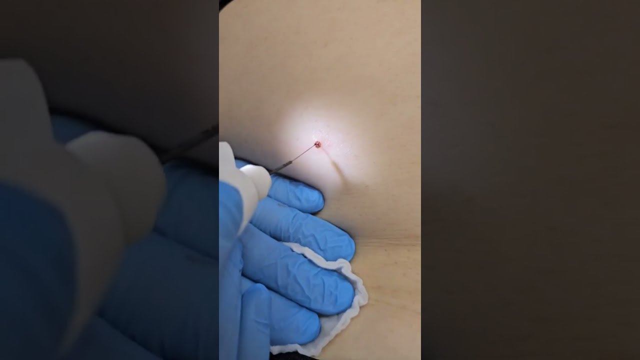 Удаление сосудистого образования