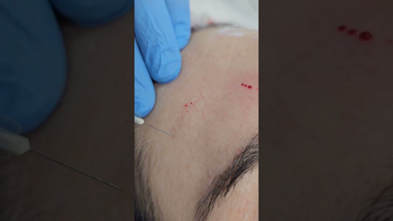 Коррекция морщин: Belotero Soft в технике «бланшинг»